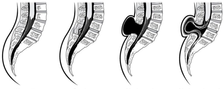 Meningocele: Entenda O Que É A Espinha Bífida E Seus 3 Tipos
